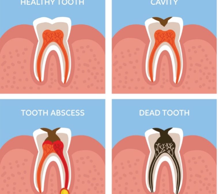 Do I Need A Root Canal If There Is No Pain Modern Care Endodontics